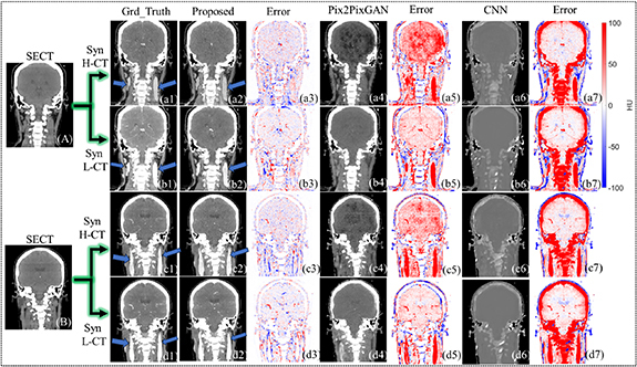 CT-based synthetic contrast-enhanced dual-energy CT generation using conditional denoising ...