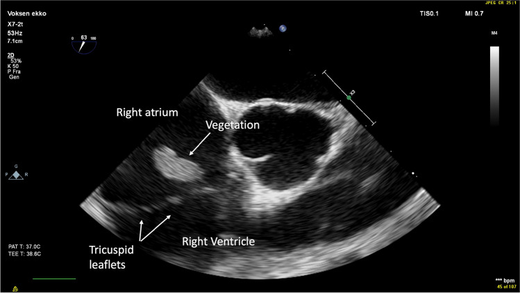Role of echocardiography in the diagnosis and clinical management of infective endocarditis - PMC