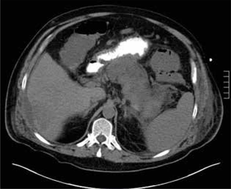 Hepatic Infarction And Acute Pancreatitis A Case Report And Review Of