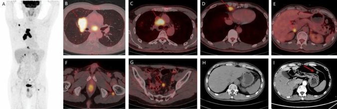 Fluorodeoxyglucose (FDG) PET/CT imaging analysis and clinical treatment evaluation in patients ...