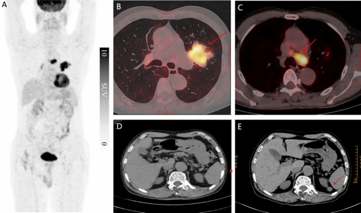 Fluorodeoxyglucose (FDG) PET/CT imaging analysis and clinical treatment evaluation in patients ...
