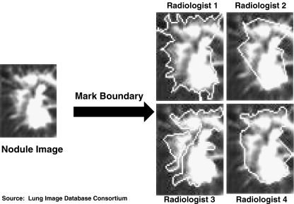 Mapping LIDC, RadLex™, and Lung Nodule Image Features - PMC