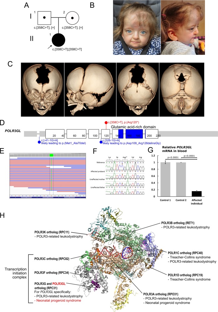 A variant of neonatal progeroid syndrome, or Wiedemann–Rautenstrauch syndrome, is associated ...