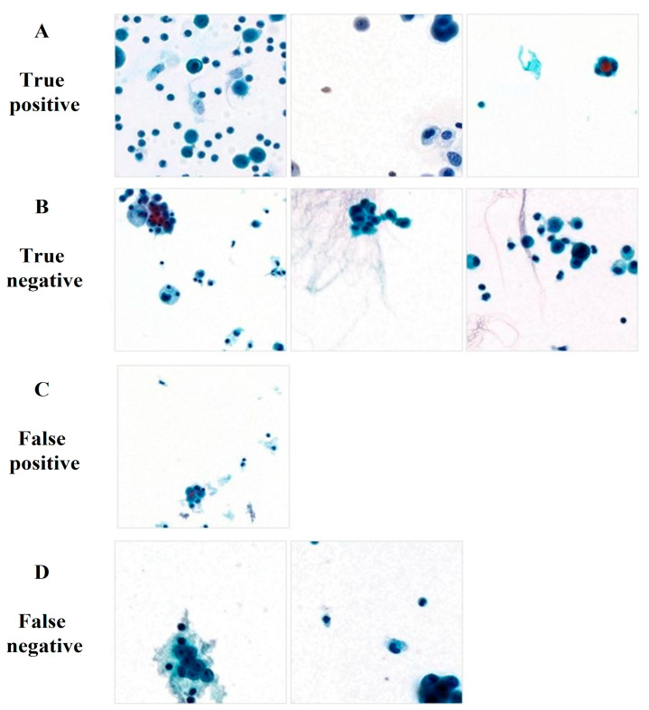 Deep Learning-Based Computational Cytopathologic Diagnosis of ... Deep Learning-Based Computational Cytopathologic Diagnosis of ...