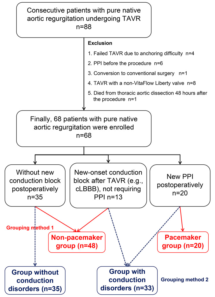 Predictors for new-onset conduction block in patients with pure native aortic regurgitation ...