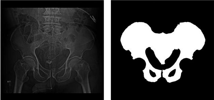 Deep-learning-based pelvic automatic segmentation in pelvic fractures - PMC