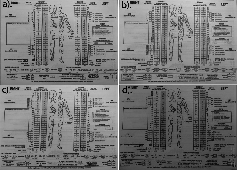 A rare cause of neurological deterioration to complete paraplegia after ...