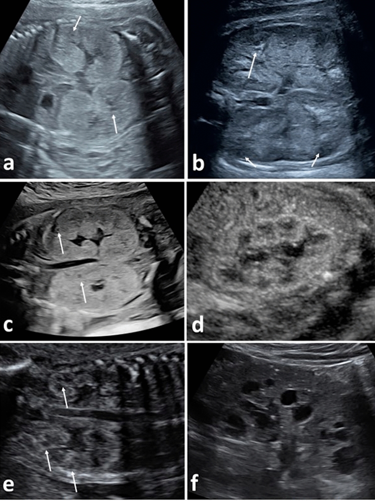 Prenatal ultrasound in fetuses with polycystic kidney appearance — expanding the diagnostic ...