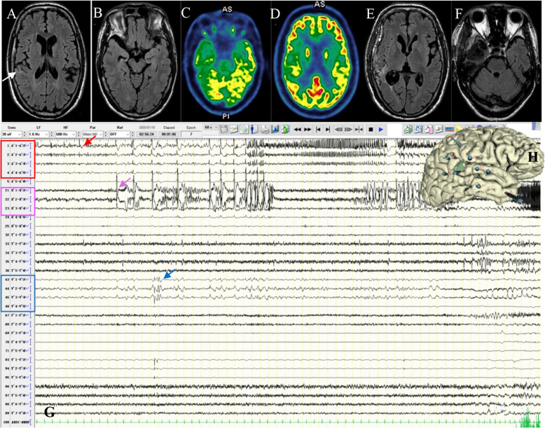 Surgical treatment of long-term epilepsy-associated tumors guided by ...