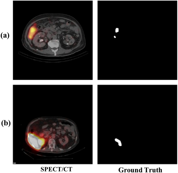 A Paired Multi Scale Attention Network For Liver Tumor Segmentation In 99mtc Maa Spect Ct