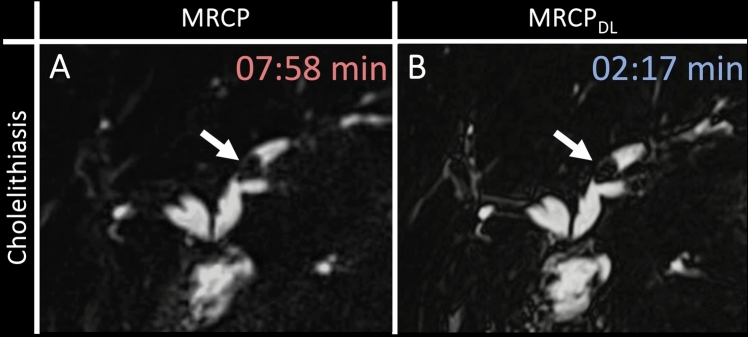 Deep learning reconstruction for accelerated 3-D magnetic resonance cholangiopancreatography - PMC