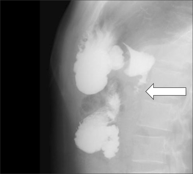 Laparoscopic Treatment Of Annular Pancreas In Adults Report Of A Case