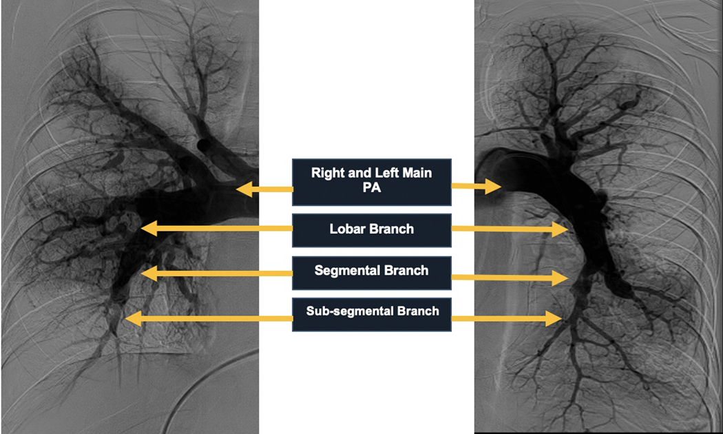 Invasive Pulmonary Angiogram Performance and Interpretation in the Diagnosis of Pulmonary ...