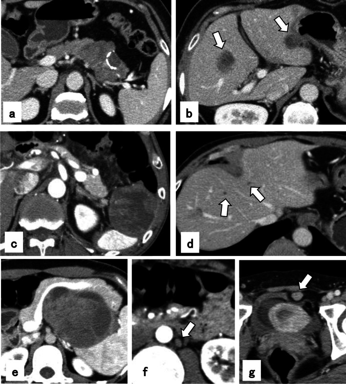 Multidisciplinary treatment of advanced or recurrent solid pseudopapillary neoplasm of the ...