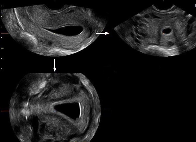 The Current Status Of Three Dimensional Ultrasonography In Gynaecology