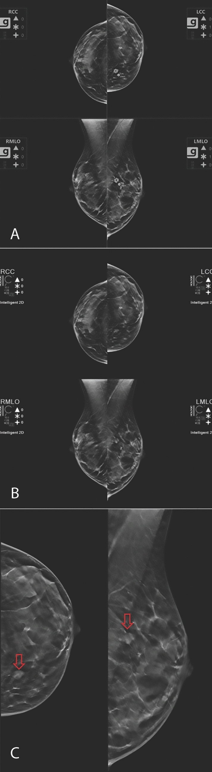 Traditional versus modern approaches to screening mammography: a ...