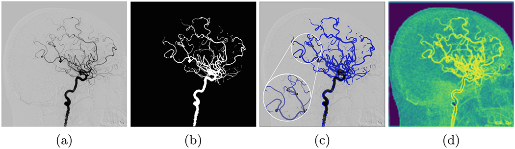 Estimation Of High Framerate Digital Subtraction Angiography Sequences
