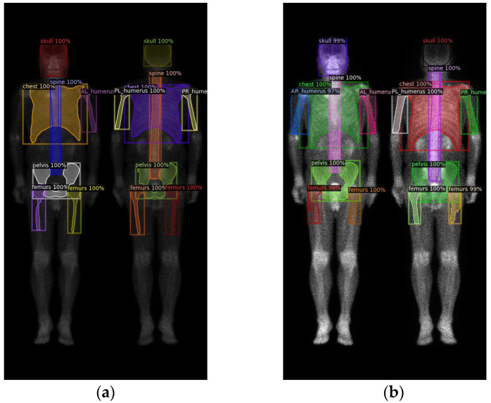 Skeleton Segmentation on Bone Scintigraphy for BSI Computation - PMC