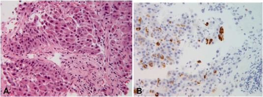 Sex‐specific Analysis Post‐liver Transplantation In Hemochromatosis With Aplastic Anemia And