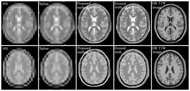 MRI Upsampling Using Feature-Based Non-Local Means Approach - PMC