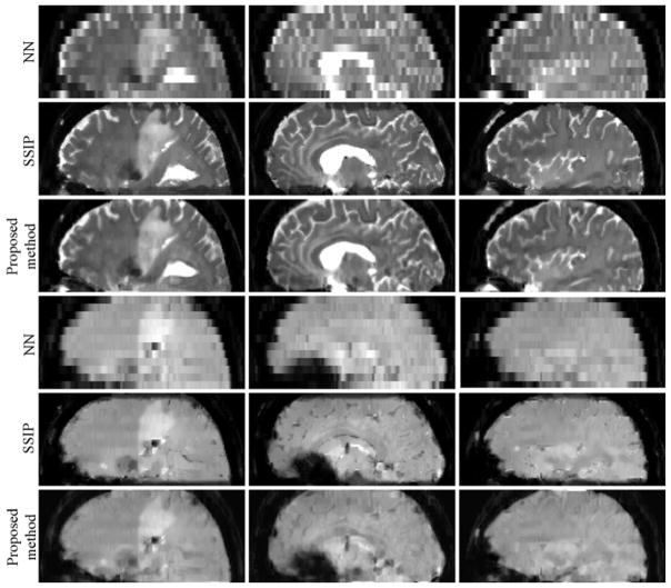 MRI Upsampling Using Feature-Based Non-Local Means Approach - PMC