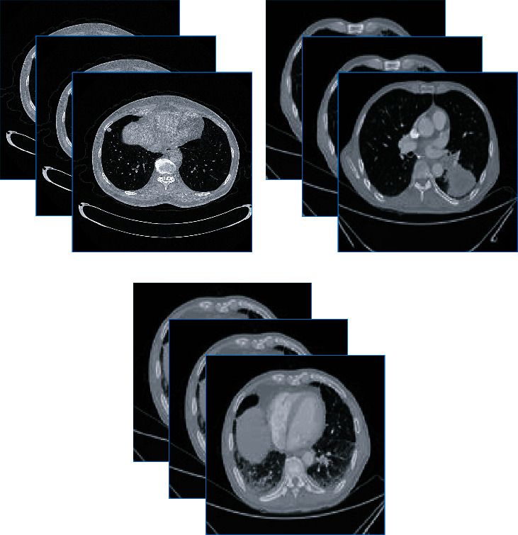 Lung Nodule Segmentation and Recognition Algorithm Based on Multiposition U-Net - PMC