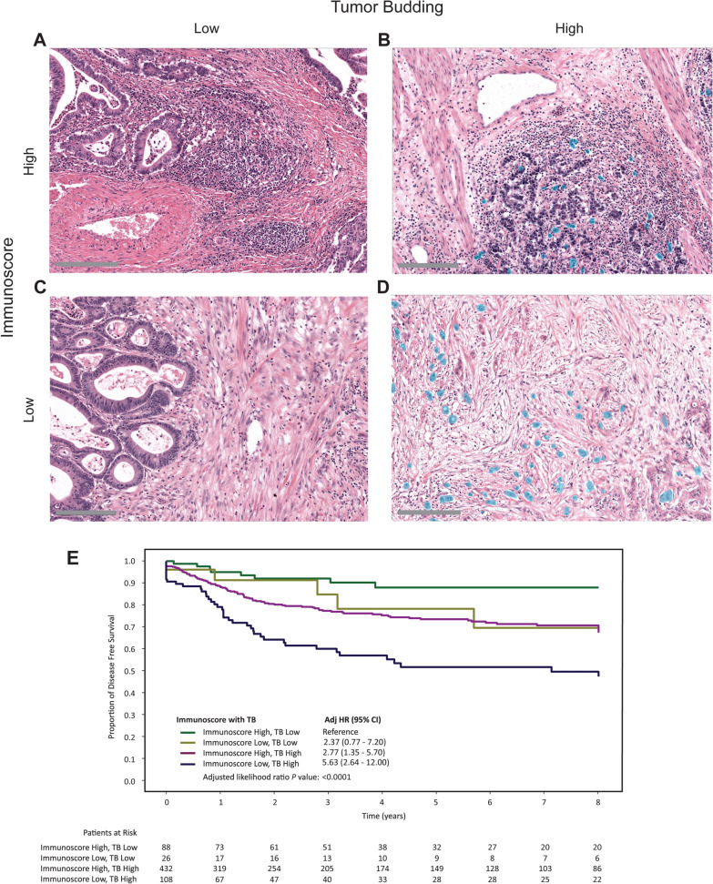 Combining immunoscore and tumor budding in colon cancer: an insightful prognostication based on ...