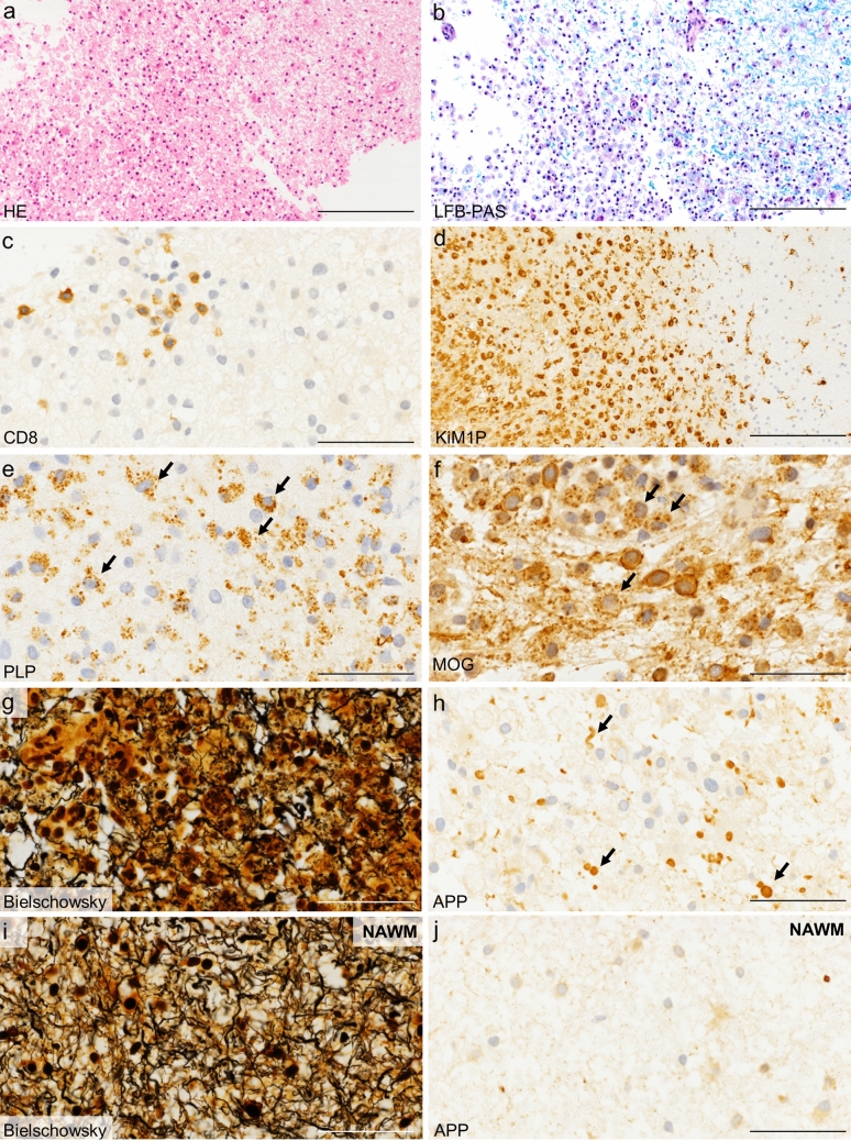 Neurofilament light chains in serum as biomarkers of axonal damage in early MS lesions: a ...