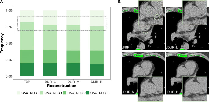 Impact of deep learning image reconstructions (DLIR) on coronary artery calcium quantification - PMC