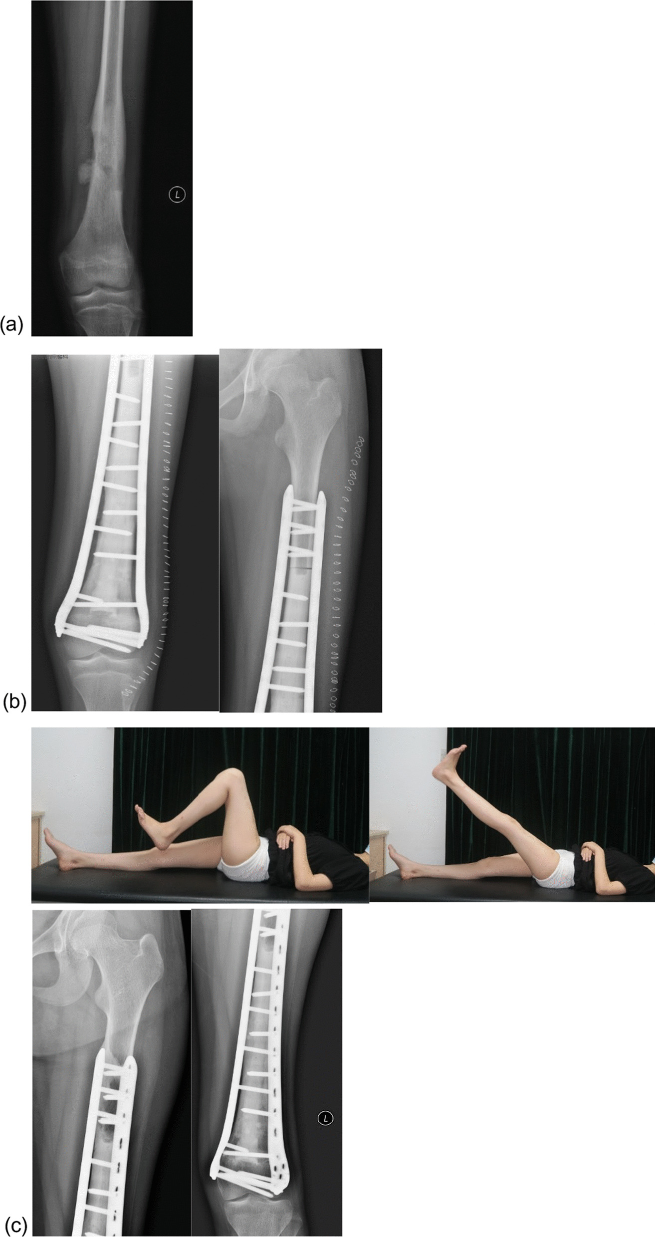 A comparative study of reconstruction modalities after knee joint-preserving tumor resection ...