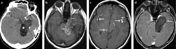 Rare And Challenging Extra Axial Brain Lesions Ct And Mri Findings With Clinico Radiological