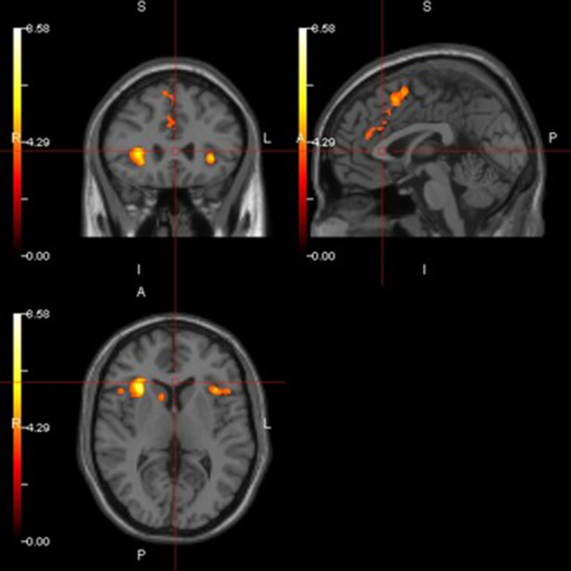 Brain Functional Mechanisms in Attentional Processing Following Modified Conflict Stroop Task - PMC