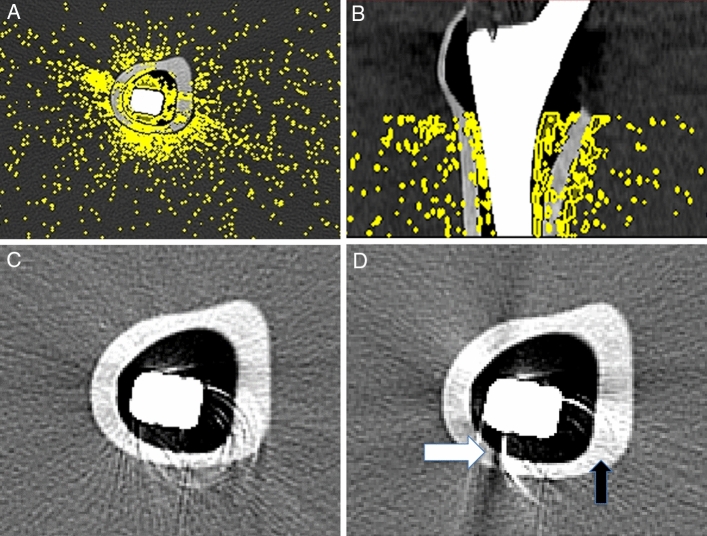 A Semi Automated Quantitative Comparison Of Metal Artifact Reduction In Photon Counting Computed