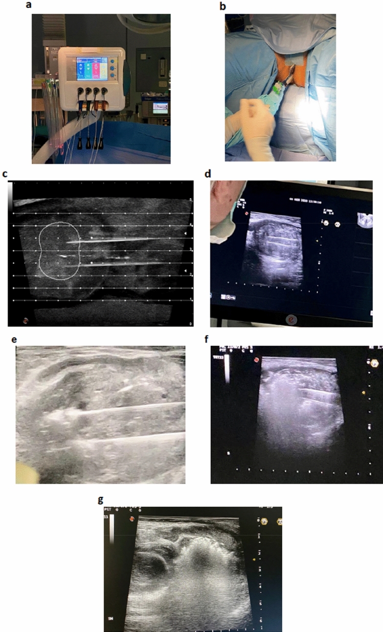 Ultrasound-guided SoracteLite™ transperineal laser ablation (TPLA) of the prostate for the ...