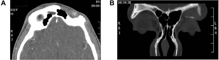 The Serious Complications Of Frontal Sinusitis A Case Series And