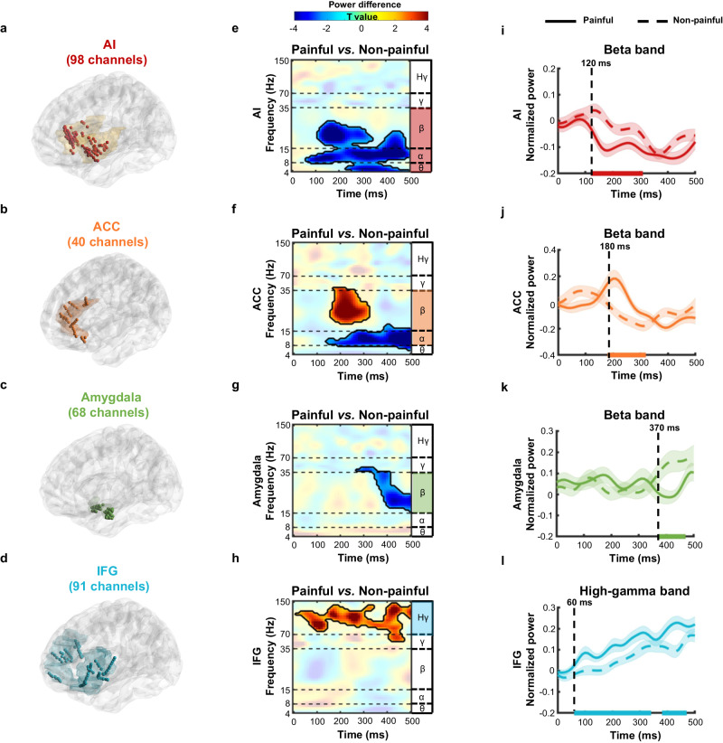 Intracranial EEG signals disentangle multi-areal neural dynamics of vicarious pain perception - PMC