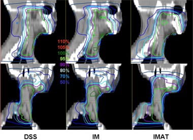 Direct machine parameter optimization for intensity modulated radiation ...