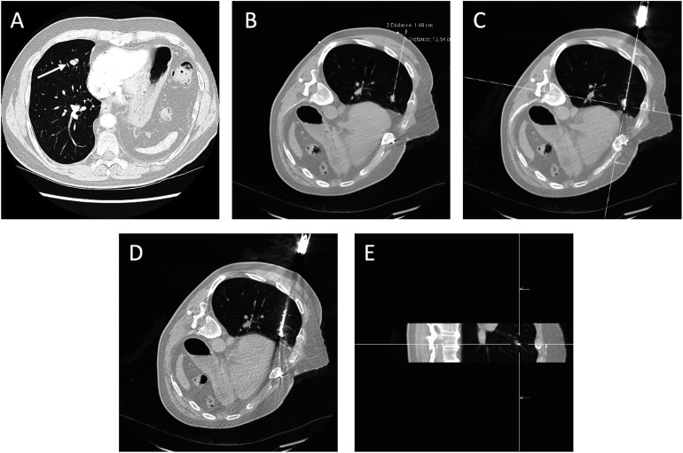 Image Guided Percutaneous And Transarterial Therapies For Primary And Metastatic Lung Cancer Pmc