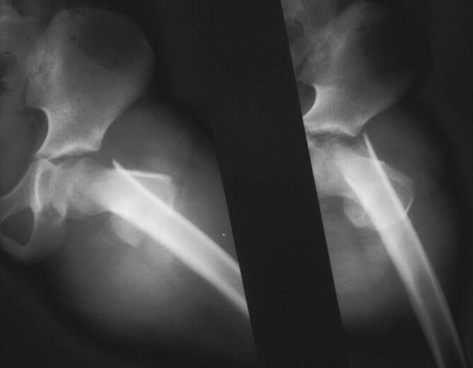 Elastisch-stabile intramedulläre Nagelung pertrochantärer Femurfrakturen im Kleinkindesalter