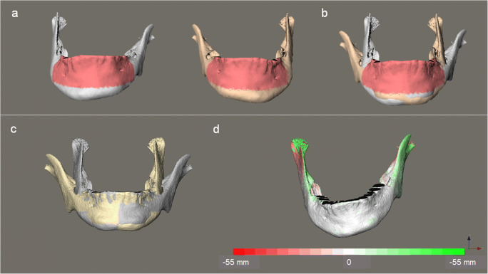 Three-dimensional characterization of mandibular asymmetry in craniofacial microsomia - PMC