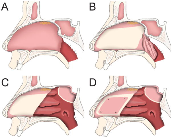 Reducing Nasal Morbidity After Skull Base Reconstruction with the Nasoseptal Flap: Free Middle ...