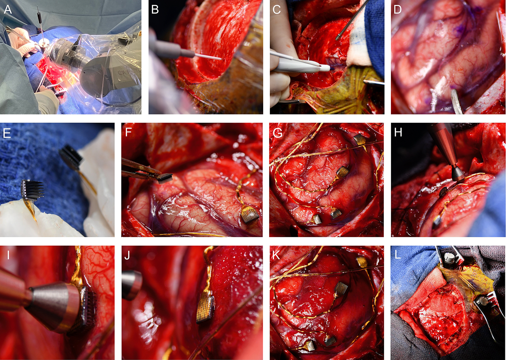 A Novel Robot-Assisted Method for Implanting Intracortical Sensorimotor Devices for Brain ...
