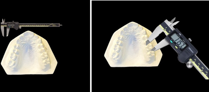 Reproducibility and reliability of dental arch measurements: comparing ...