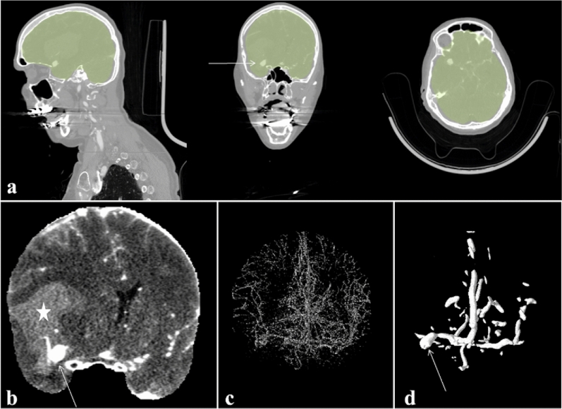 Fully automated detection and segmentation of intracranial aneurysms in subarachnoid hemorrhage ...
