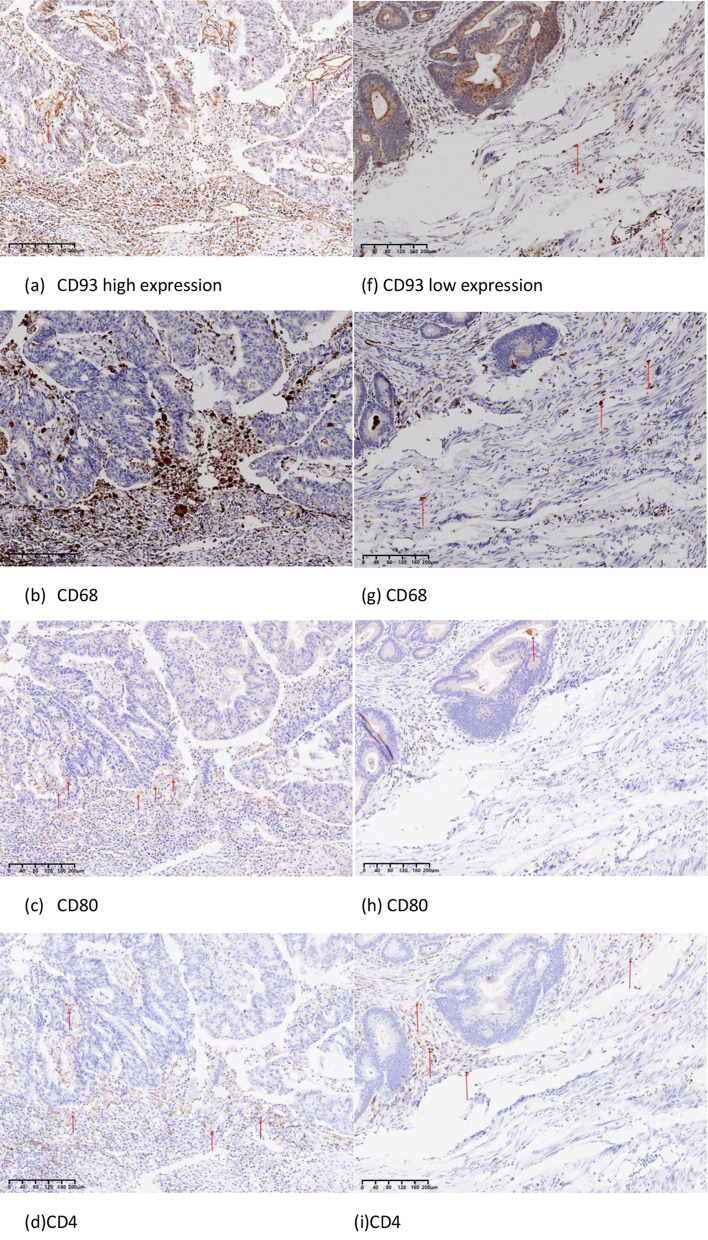 Expression and prognostic significance of CD93 in blood vessels in colorectal cancer: an ...