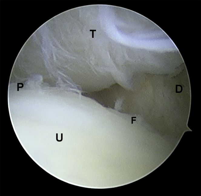 Arthroscopic-Assisted Inside-Out Foveal Reattachment of Triangular Fibrocartilage Complex - PMC