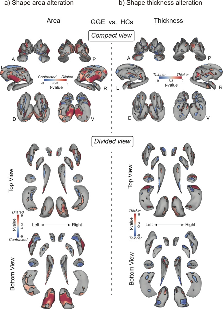 Chemoarchitectural signatures of subcortical shape alterations in generalized epilepsy - PMC