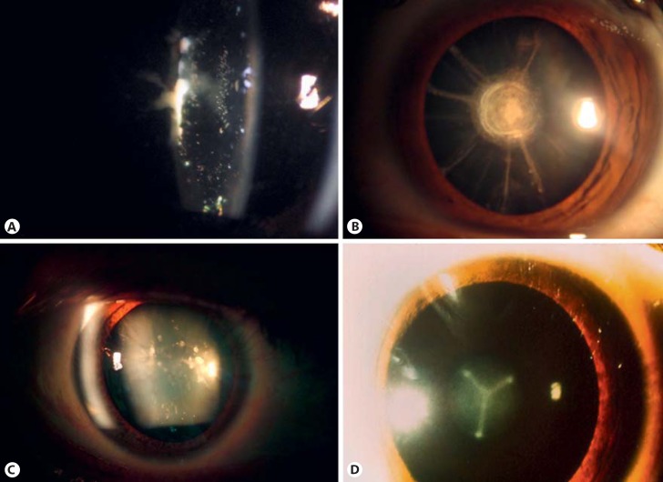 Inherited Congenital Cataract A Guide To Suspect The Genetic Etiology