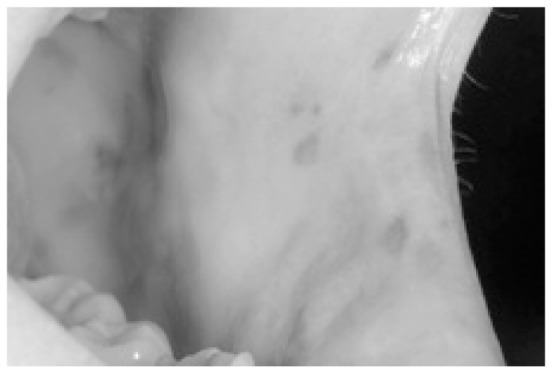 Multiple Melanotic Macules Of Unknown Origin Pmc