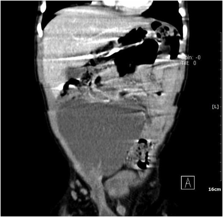 Abdominoscrotal Hydrocele A Case Report Pmc